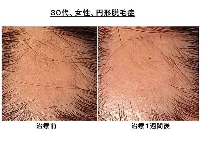 30年間治らなかった円形脱毛症、治療1週間で、もう産毛が増えました！ 患者様からの声・メディア掲載・クリニックからのお知らせ 名古屋kクリニック